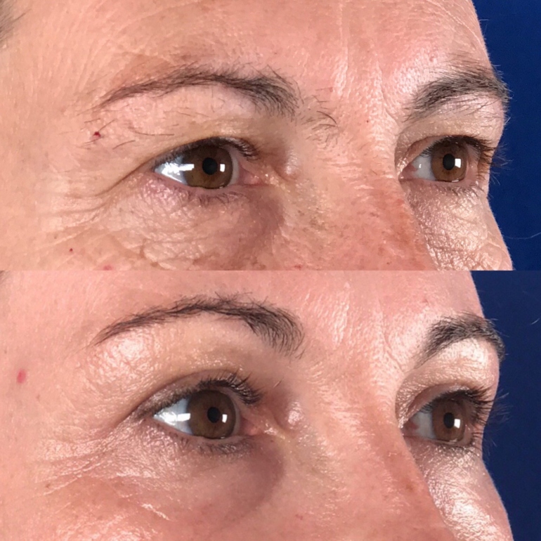 Blepharoplasty: The signature EYELight360 by Dr Nerina Wilkinson
