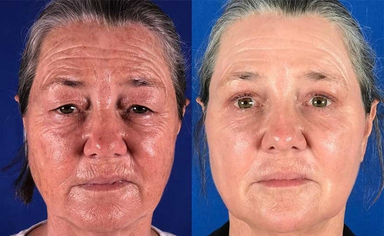 Stem Cell Facelifts South Africa - Dr Nerina Wilkinson + Associates