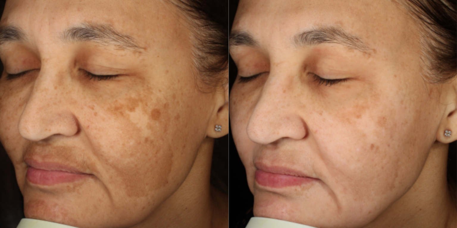Melasma Treatments and Results - Dr Nerina Wilkinson + Associates