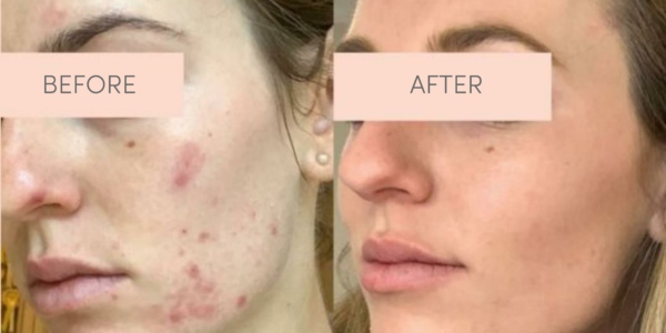 Everything You Need To Know About Chemical Peels - Dr Nerina Wilkinson ...