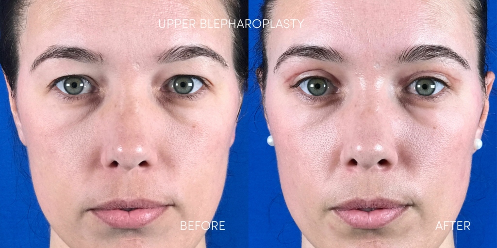5 of the Best Eyelid Rejuvenation Options and their Results - Dr Nerina ...