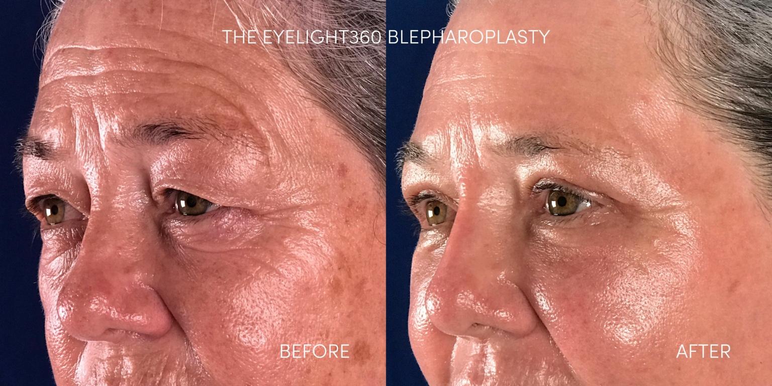5 of the Best Eyelid Rejuvenation Options and their Results - Dr Nerina ...