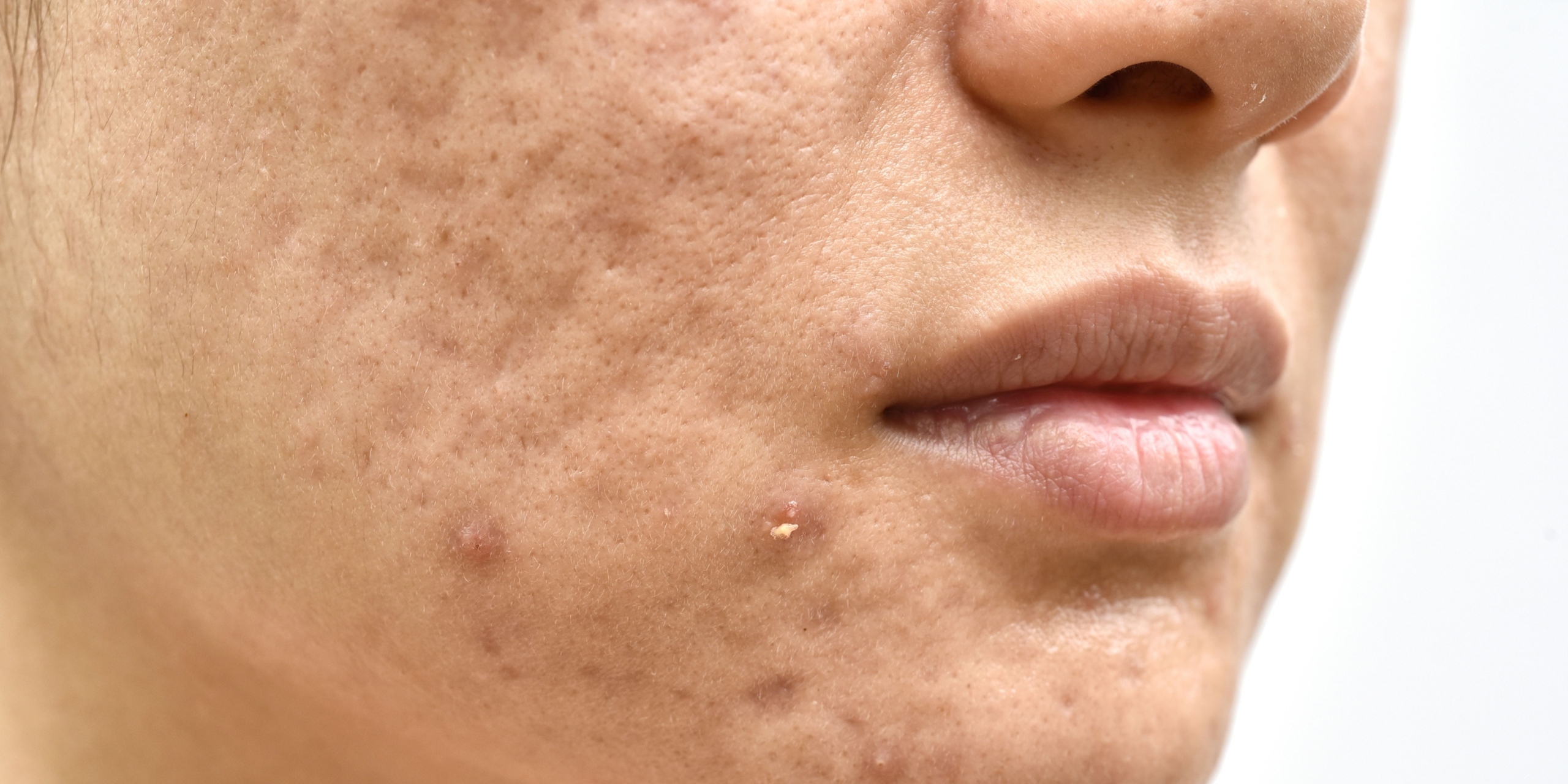 Everything You Need To Know About Acne Scarring - Dr Nerina Wilkinson ...