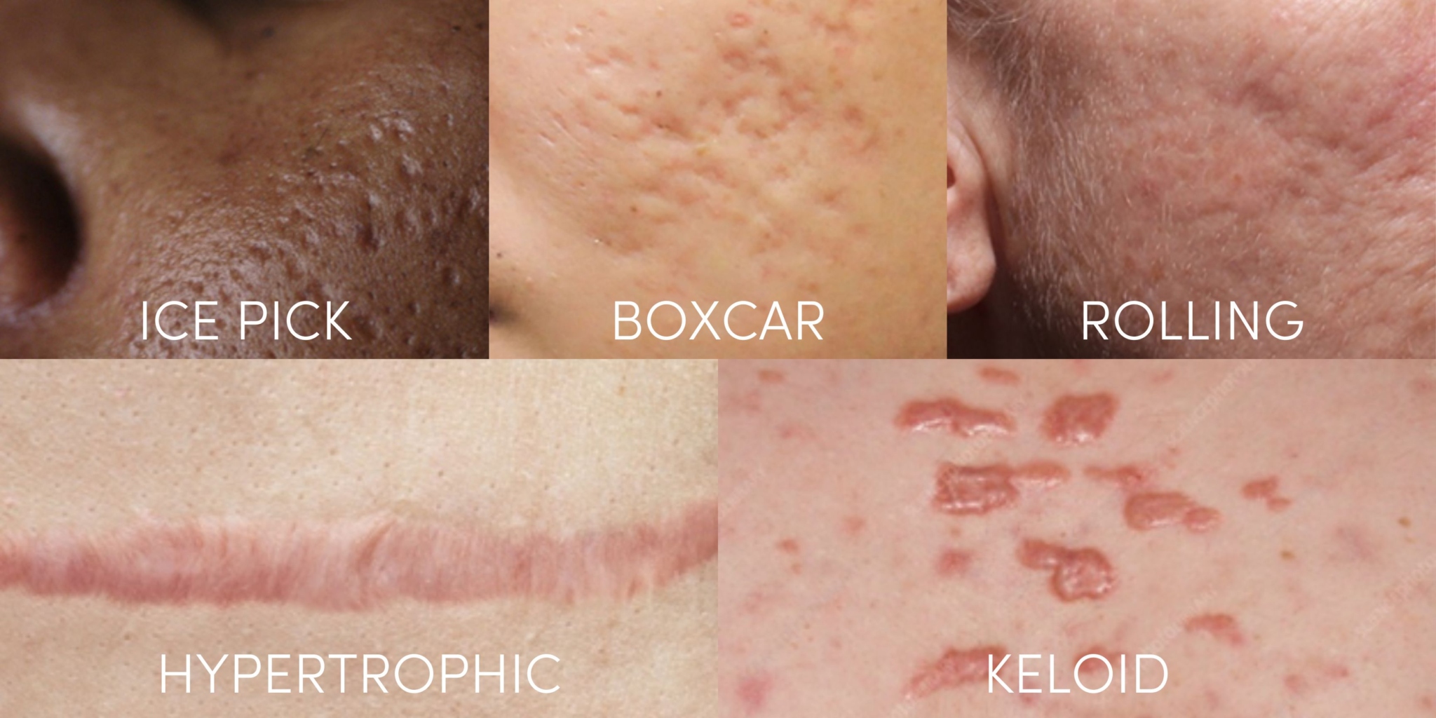 Everything You Need To Know About Acne Scarring - Dr Nerina Wilkinson ...