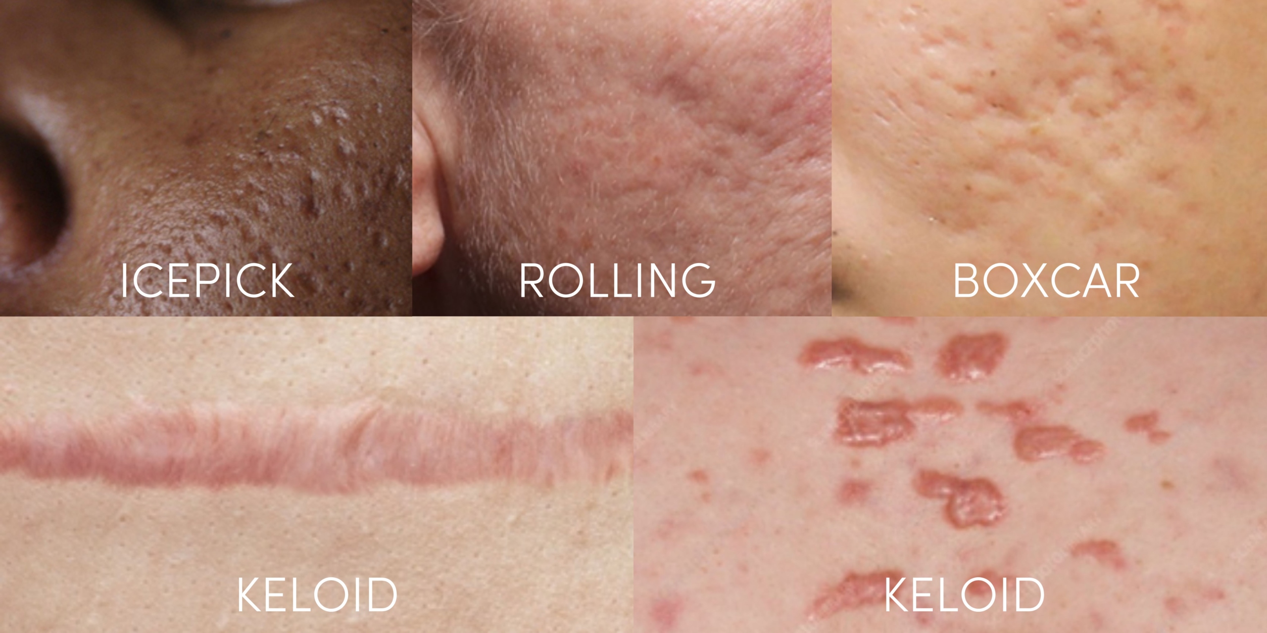 Everything You Need To Know About Acne Scarring - Dr Nerina Wilkinson ...