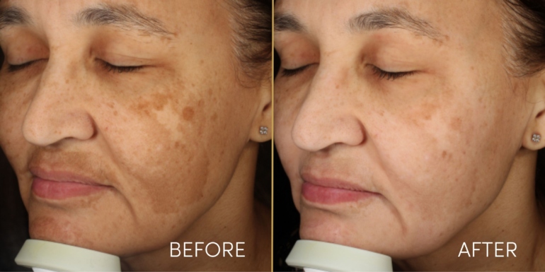 Top Pigmentation Treatments & Scientific Advances of 2024 - Dr Nerina ...